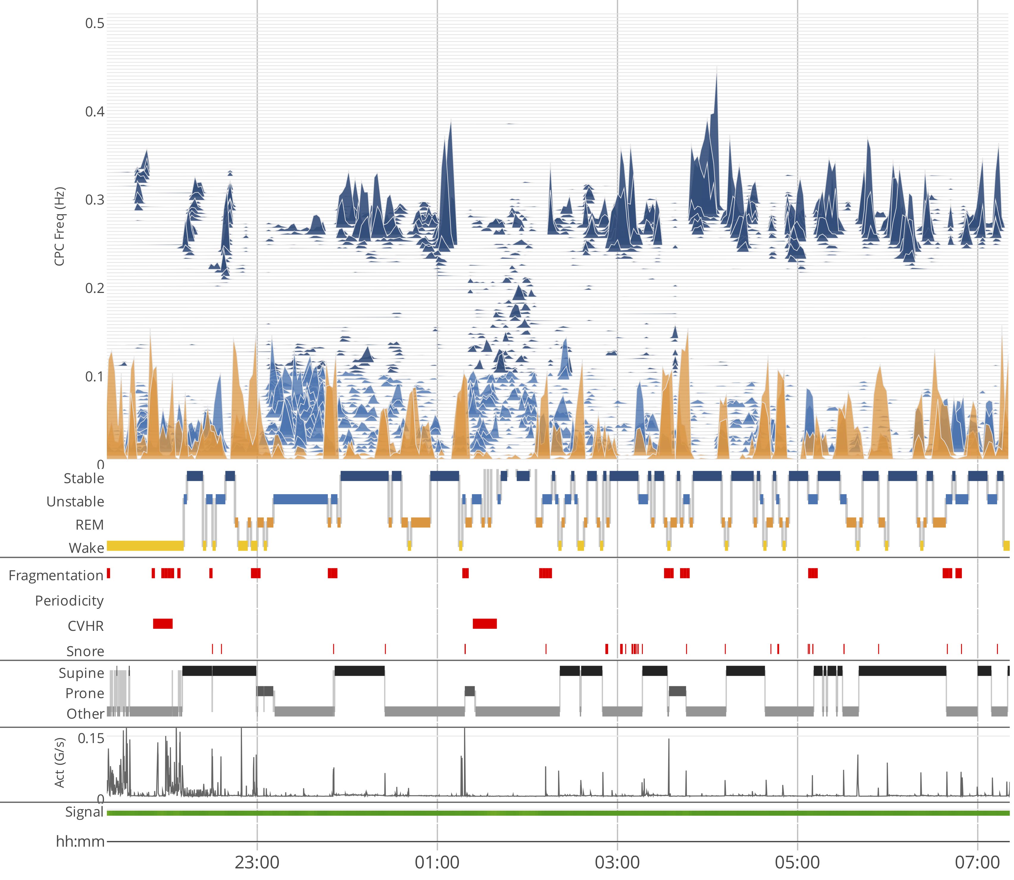 AdultInsomnia12 – SleepImage